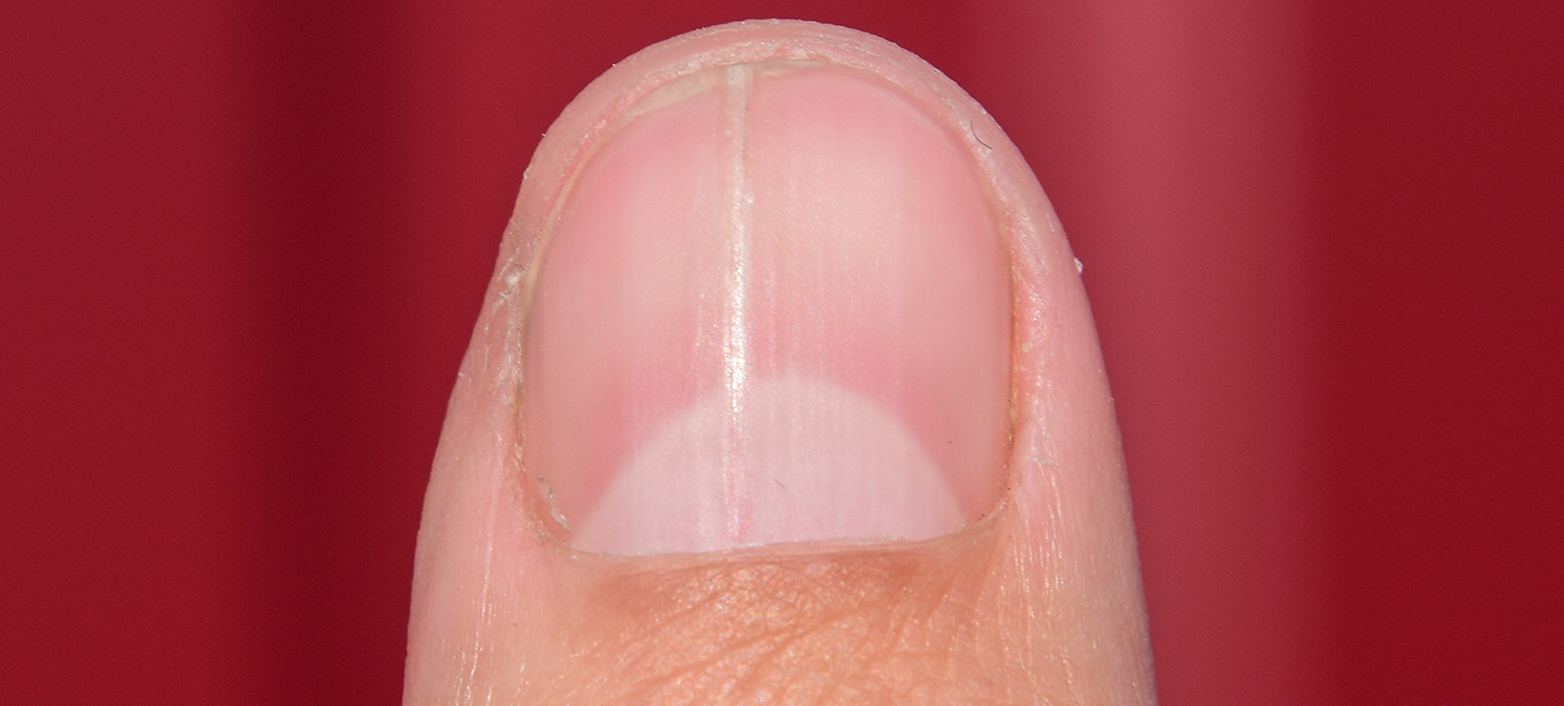 Nail Signs: ନଖ କହିବ ଆପଣଙ୍କ ରୋଗ; ଏହି ୭ଟି ସଙ୍କେତ ଭାରି ଖରାପ... Nail signs ...