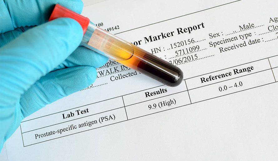 Psa Screening